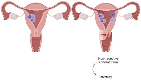 High Risk Of Chronic Endometritis In Isthmocele—a Systematic Review And