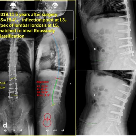 The Four Types Of The Roussouly Sagittal Classification The Shape Of