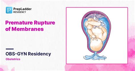 Premature Rupture Of Membranes Prepladder