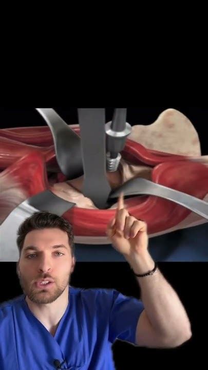 მენჯ ბარძაყის პროთეზირება ექიმი სამედიცინო მედიცინა Youtube