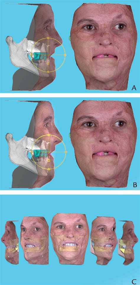 Figure 1 From Integrating Hinge Axis Approximation And The Virtual
