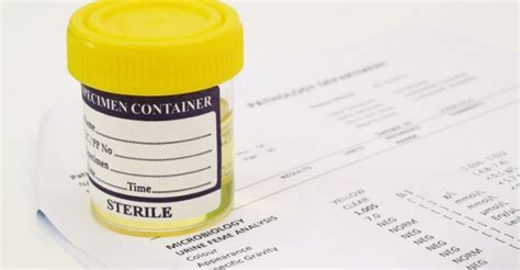 ازمایش ردیوسینگ Reducing Substance Urine آزمایشگاه تخصصی کوثر مشهد