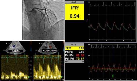 An Example Of Concordant High Ffr Cfr And Ifr In A Patient With A Download Scientific Diagram