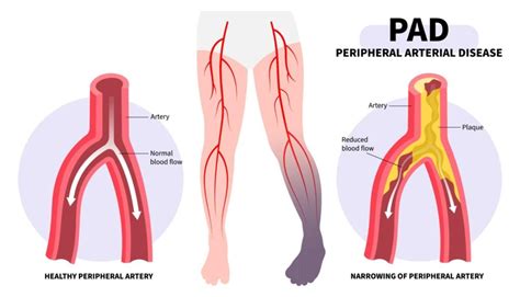 What Is An Angiogram Procedure Ae