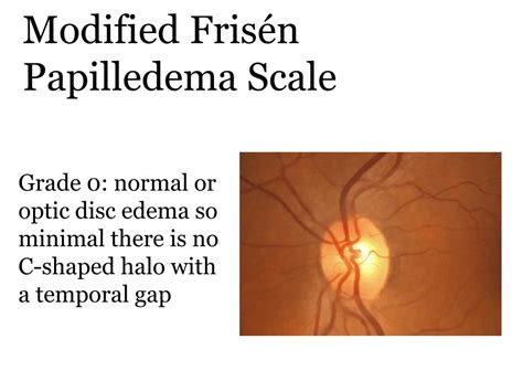 Papilledema Grading