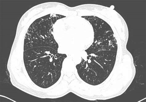 High Resolution Computed Tomography Of The Thorax Showing Tree In Bud
