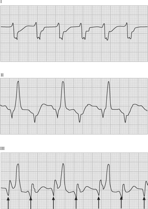 11typical Atrial Flutter Circuit 6 Red Arrows Represent The
