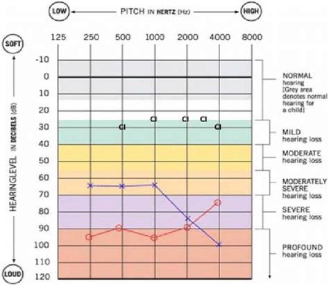 Unaided And Cochlear Implant Audiometric Thresholds Crosses Denote