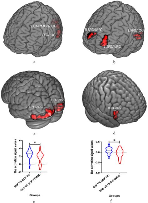 Figure 1 From Hypoactive Visual Cortex Prefrontal Cortex And Insula