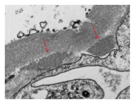 A Glomerulus With Nodularity Mesangial Hypercellularity And Download Scientific Diagram