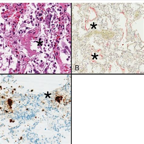Diffuse Alveolar Damage Is Characterized By Hyaline Membranes