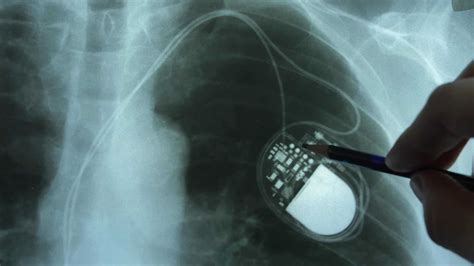 Doctor Examining X Ray Image Of Chest With Artificial Cardiac Pacemaker Radiation Safety