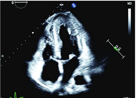 Follow Up Echocardiogram Obtained Nearly 2 Weeks Following Sternotomy