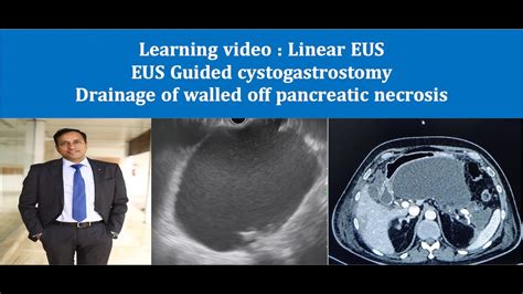 Learning Video Eus Guided Cystogastrostomy Walled Off Pancreatic