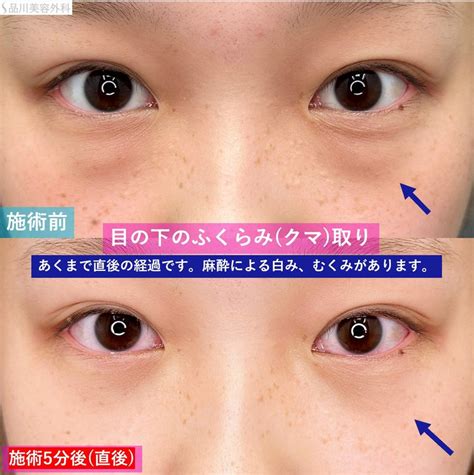 クマ取りの症例術前、直後 品川スキンクリニック院長長谷部のブログ