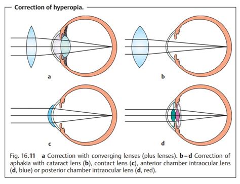 Hyperopia Lens