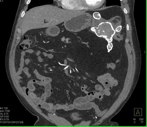 Autoinfarction Left Upper Quadrant Gastrointestinal Radiology Case