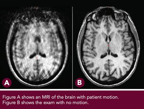 Can I Be Sedated For A Myelogram Emsekflolcom