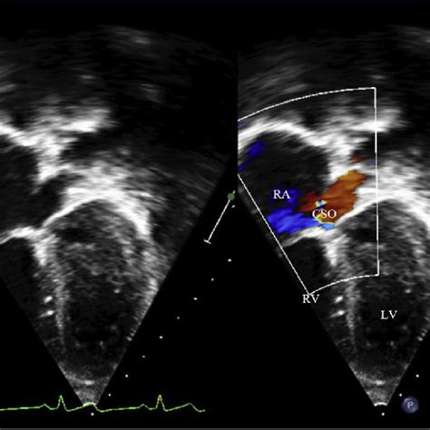 Subxiphoid Short Axis View On Transthoracic Echocardiogram CSO CS Download Scientific Diagram