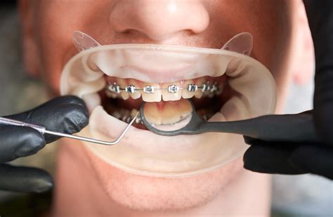 How Do Braces Work Comprehensive Guide On Orthodontics