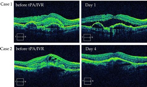 Figure 1 From Effects Of Combination Therapy With Intravitreal Ranibizumab And Tissue