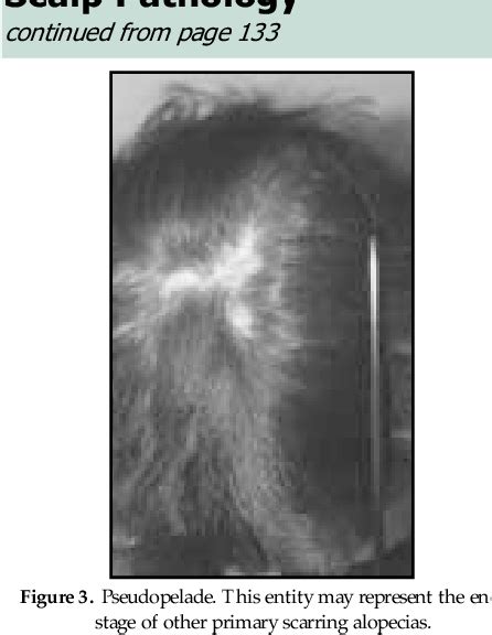 Figure 3 From Scalp Pathology For The Hair Transplant Surgeon Hair Loss Diagnosis Semantic