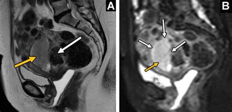 Update On Mri In Evaluation And Treatment Of Endometrial Cancer
