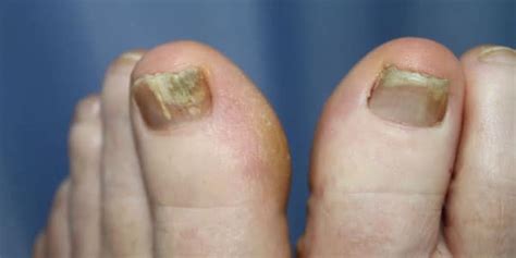 Nail Disorders Sinclair Dermatology