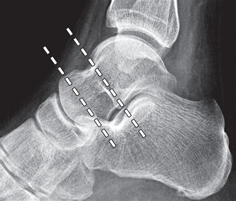 Talar Fractures And Dislocations A Radiologists Guide To Timely