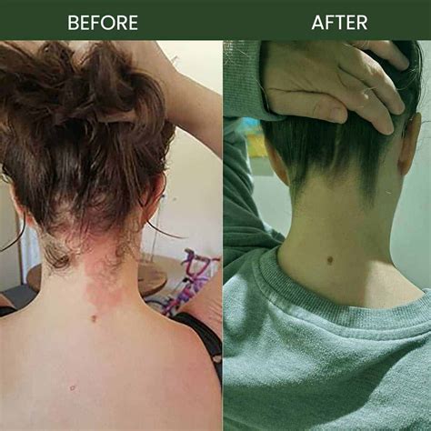 My Psoriasis Diet That Really Works Before And After Pics