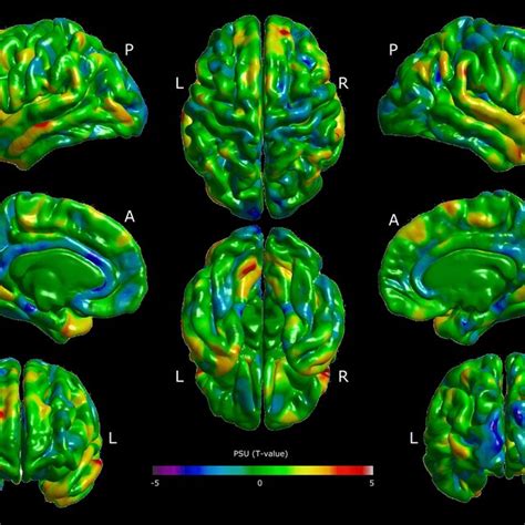 Cortical Thickness Results And Their Correlation With The University Download Scientific