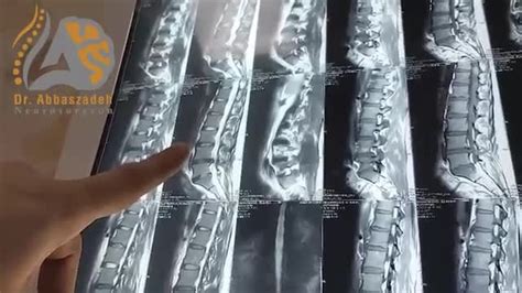 فیلم واقعی جراحى دیسک کمر در خانم 35 ساله نماشا