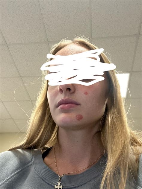 Leukemia Rash Face Polymorphous Light Eruption Lupus