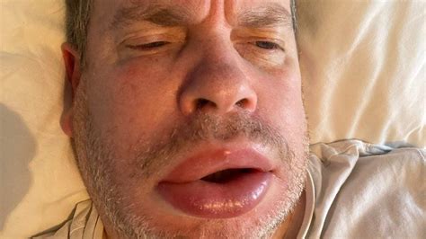 Angiodema Gene Therapy Blocks Painful Hereditary Disorder