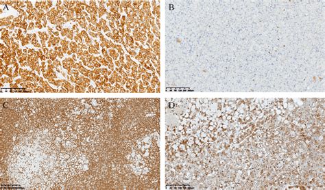 Representative Immunohistochemical Profile Of Low Grade Oncocytic Download Scientific Diagram
