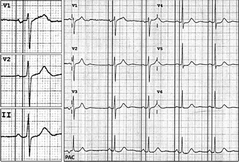 Normalization Of Interatrial Conduction After A Premature Atrial Download Scientific Diagram
