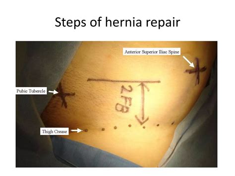 Surgical Anatomy Of Inguinal Hernia Pptx