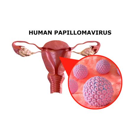 Hpv Warts On Cervix