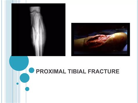 Proximal Tibia Fracture Pptx
