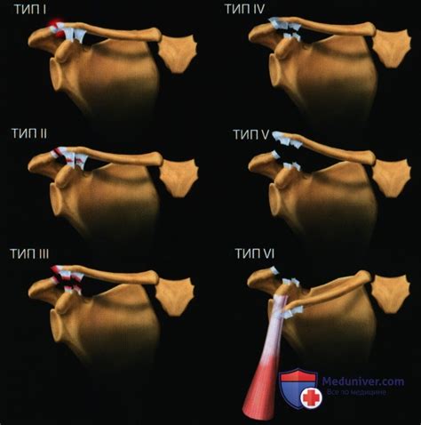 Признаки травмы акромиально ключичного сустава