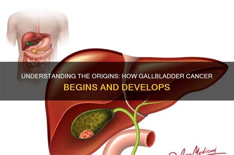 Understanding The Origins How Gallbladder Cancer Begins And Develops