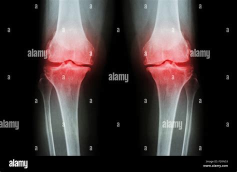 Osteoarthritis Knee Oa Knee Film X Ray Both Knee Front View Show Narrow Joint Space