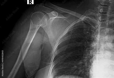 X Ray Image Of Proximal Humerus Fracture Stock Photo Adobe Stock