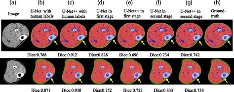 Label Efficient Segmentation Of Single Slice Thigh Ct With Two Stage Pseudo Labels