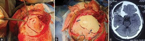 Surgical Neurology International
