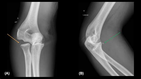 Coronoid Process Radiography