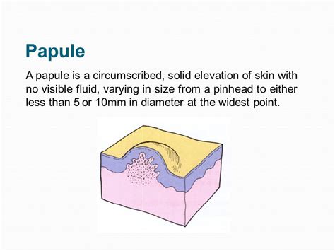 Macule Vs Papule