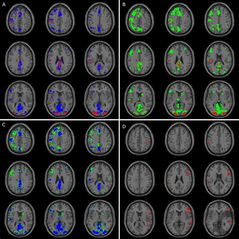 the activation maps found in ica aroma 1 regression red and