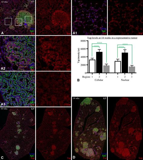 Yap Expression Becomes Heterogeneous In Tumors A Example Of A Tumor