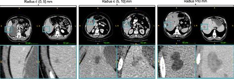 Label Free Liver Tumor Segmentation Paper And Code Catalyzex